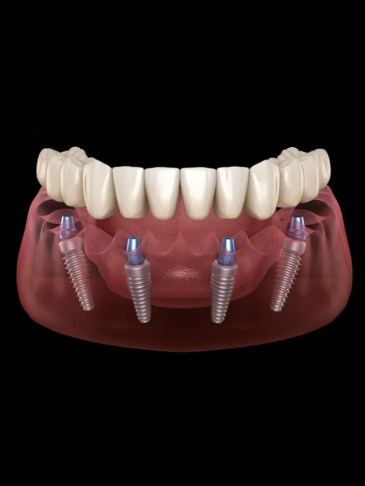All On Implant Systems - Grande Smile Clinic