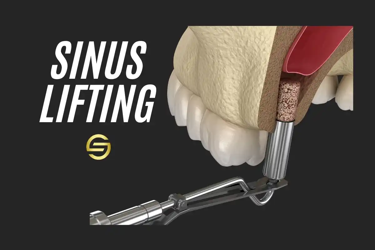 Operația de Lifting Sinusoidal: Îmbunătățiți Succesul Implanturilor și ...